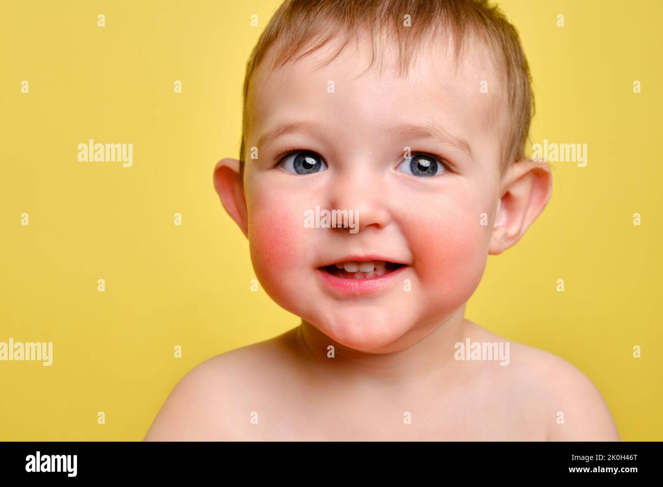 Happy toddler baby with allergies on her face, studio yellow background ...