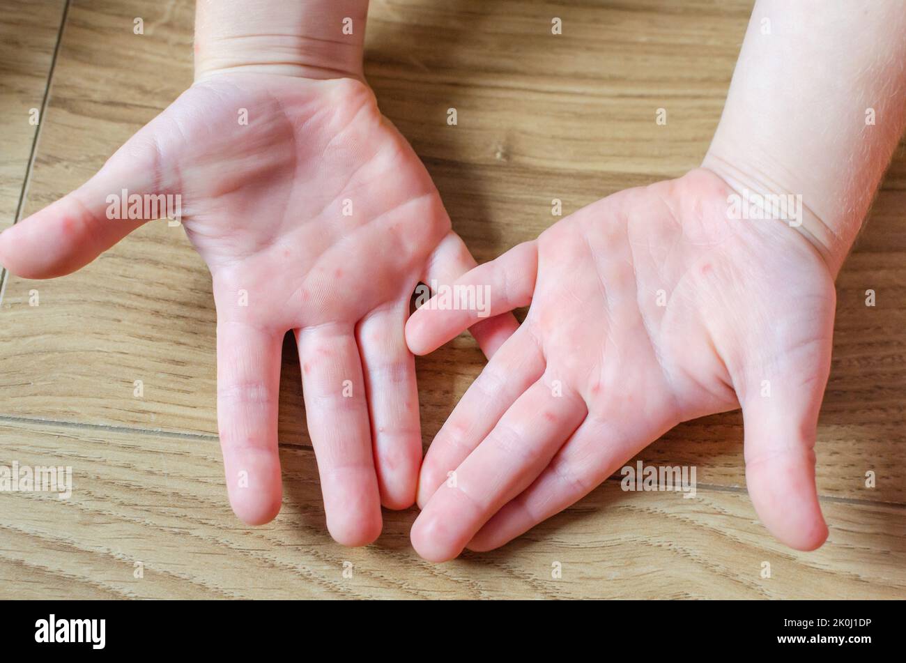 Enterovirus Hand Rash on the body of a child. Cocksackie virus rash ...