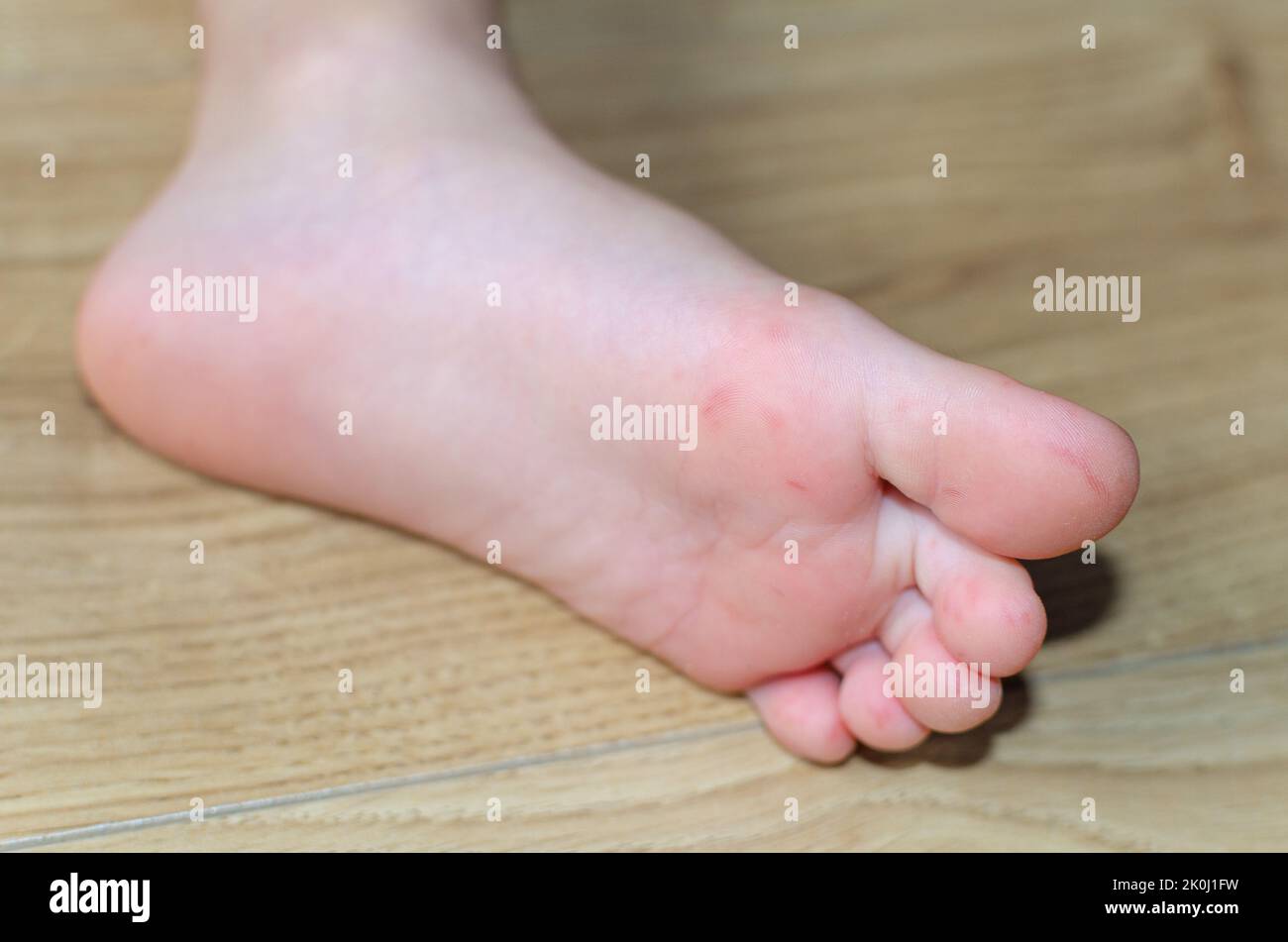 Enterovirus Feet Rash on the body of a child. Cocksackie virus rash ...