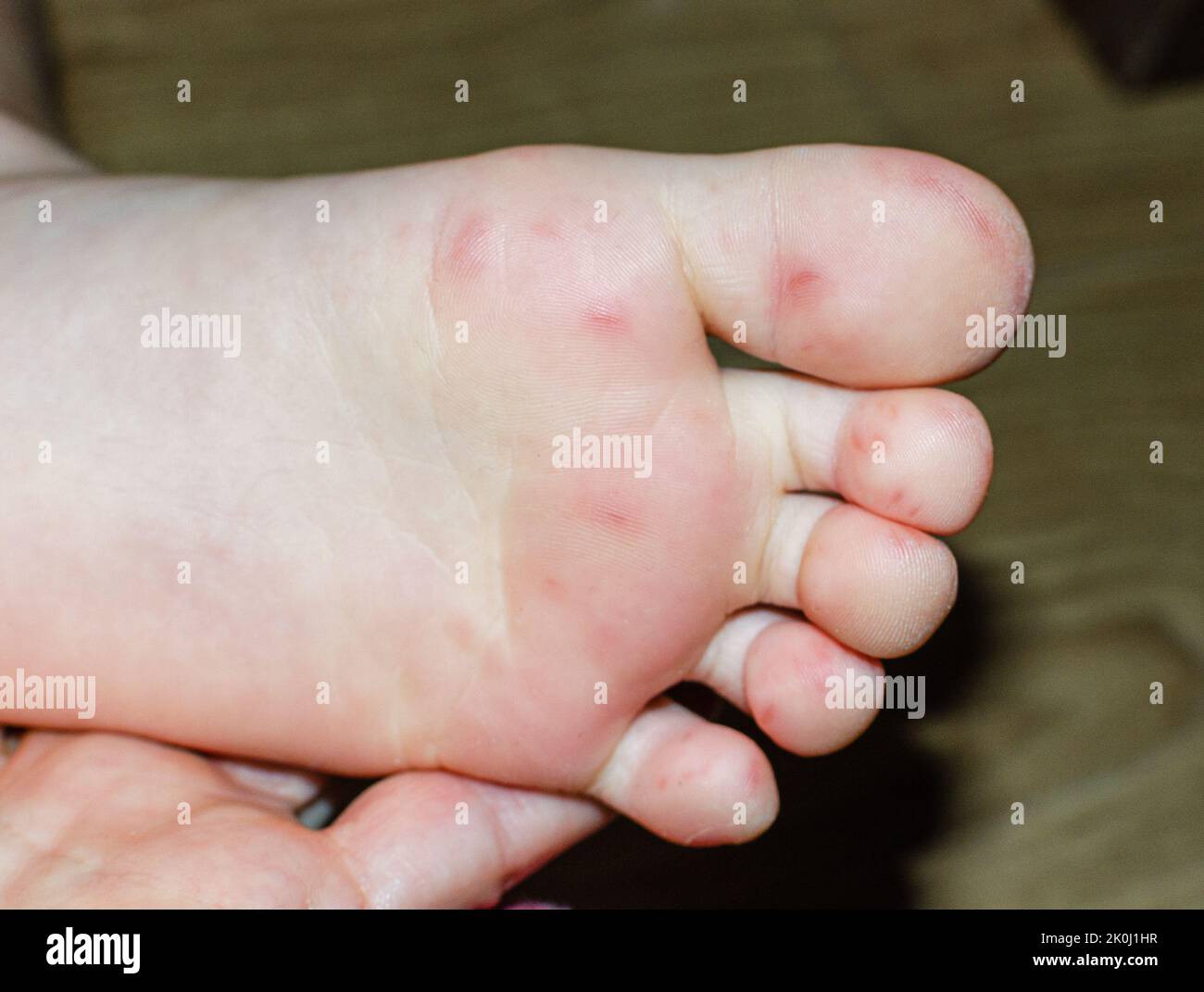 Enterovirus Feet Rash on the body of a child. Cocksackie virus rash ...