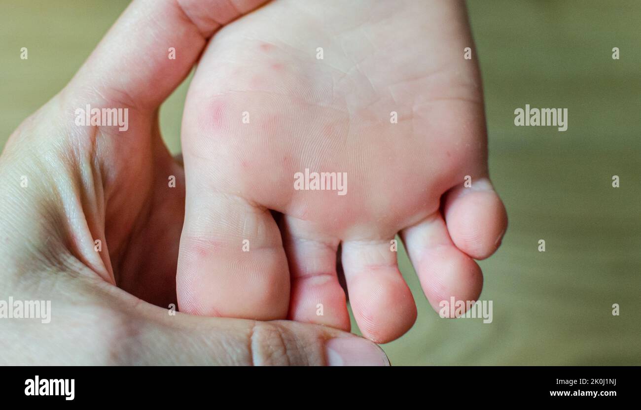 Enterovirus Feet Rash on the body of a child. Cocksackie virus rash ...