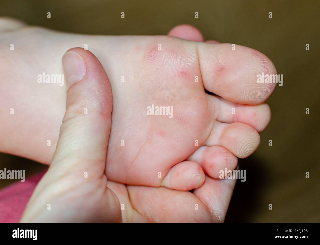 Enterovirus Feet Rash on the body of a child. Cocksackie virus rash ...