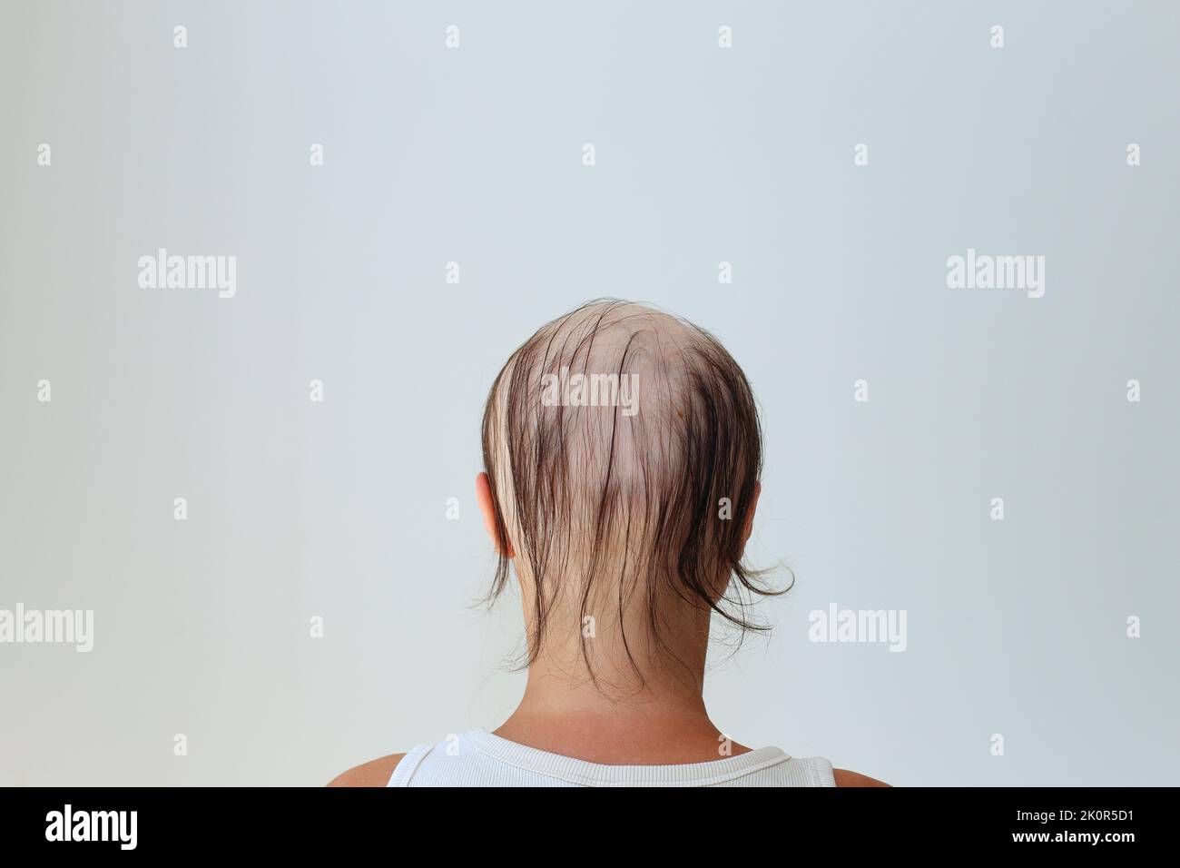 Hair loss in the form of alopecia areata. Bald head of a woman. Hair ...