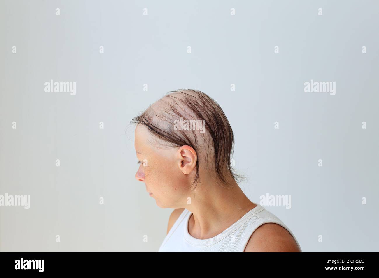 Hair loss in the form of alopecia areata. Bald head of a woman. Hair ...
