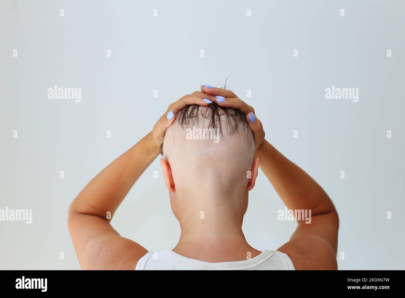 Hair loss in the form of alopecia areata. Bald head of a woman. Hair ...