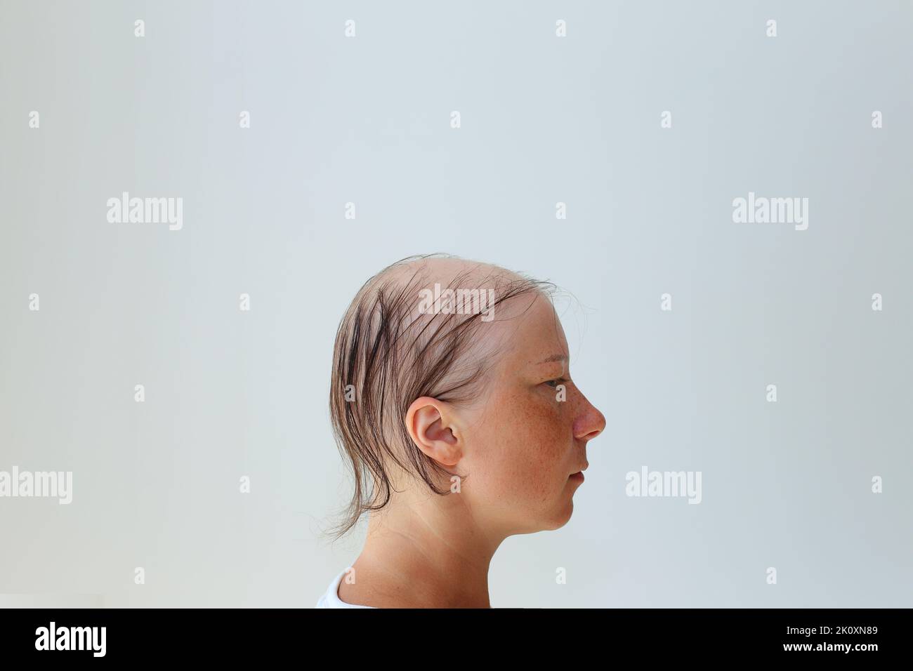 Hair loss in the form of alopecia areata. Bald head of a woman. Hair ...