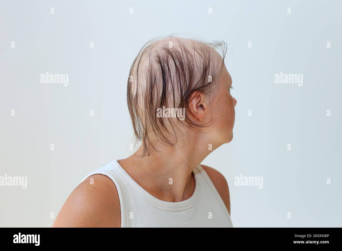 Hair loss in the form of alopecia areata. Bald head of a woman. Hair ...