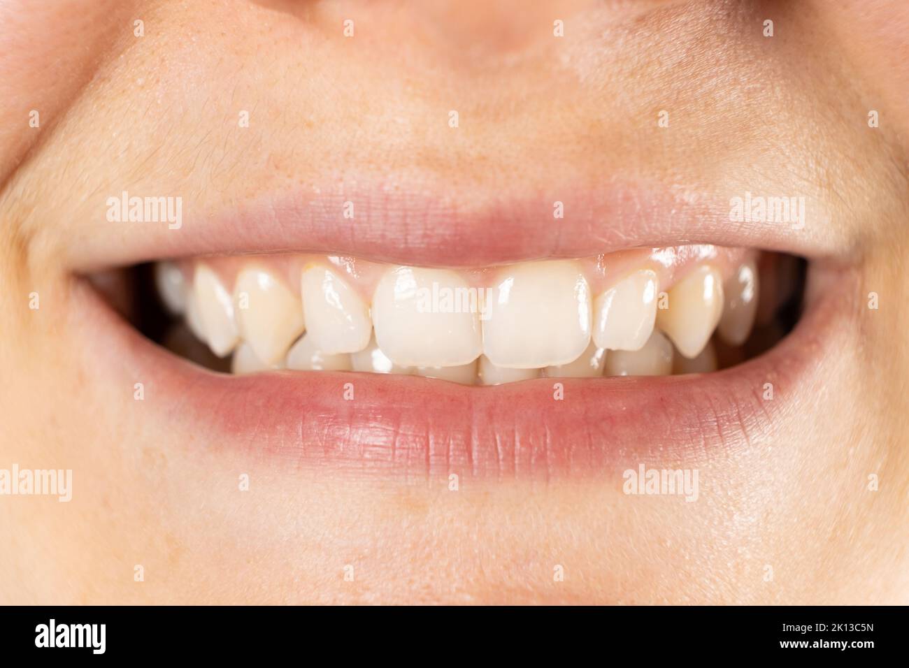 Straight teeth hi-res stock photography and images - Alamy