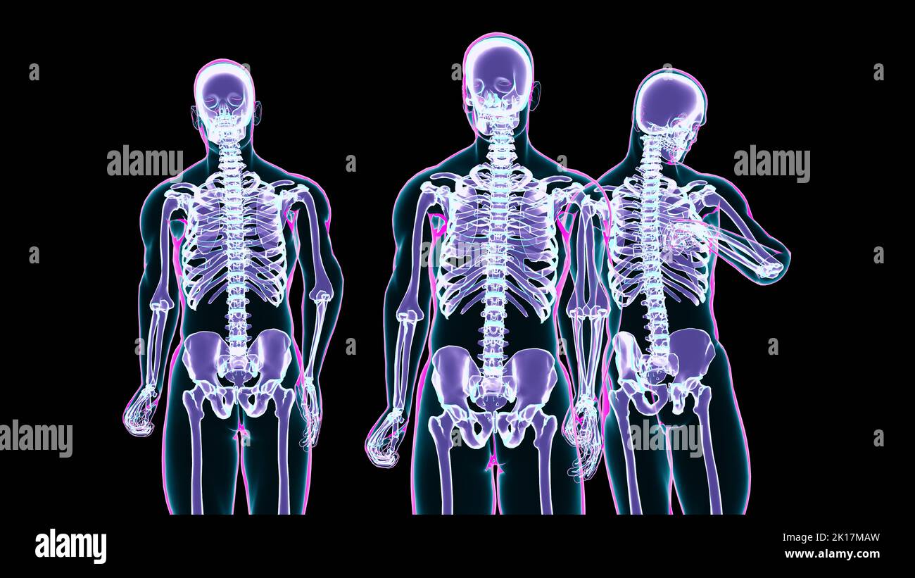 Three skeletons standing and moving normally isolated on black ...