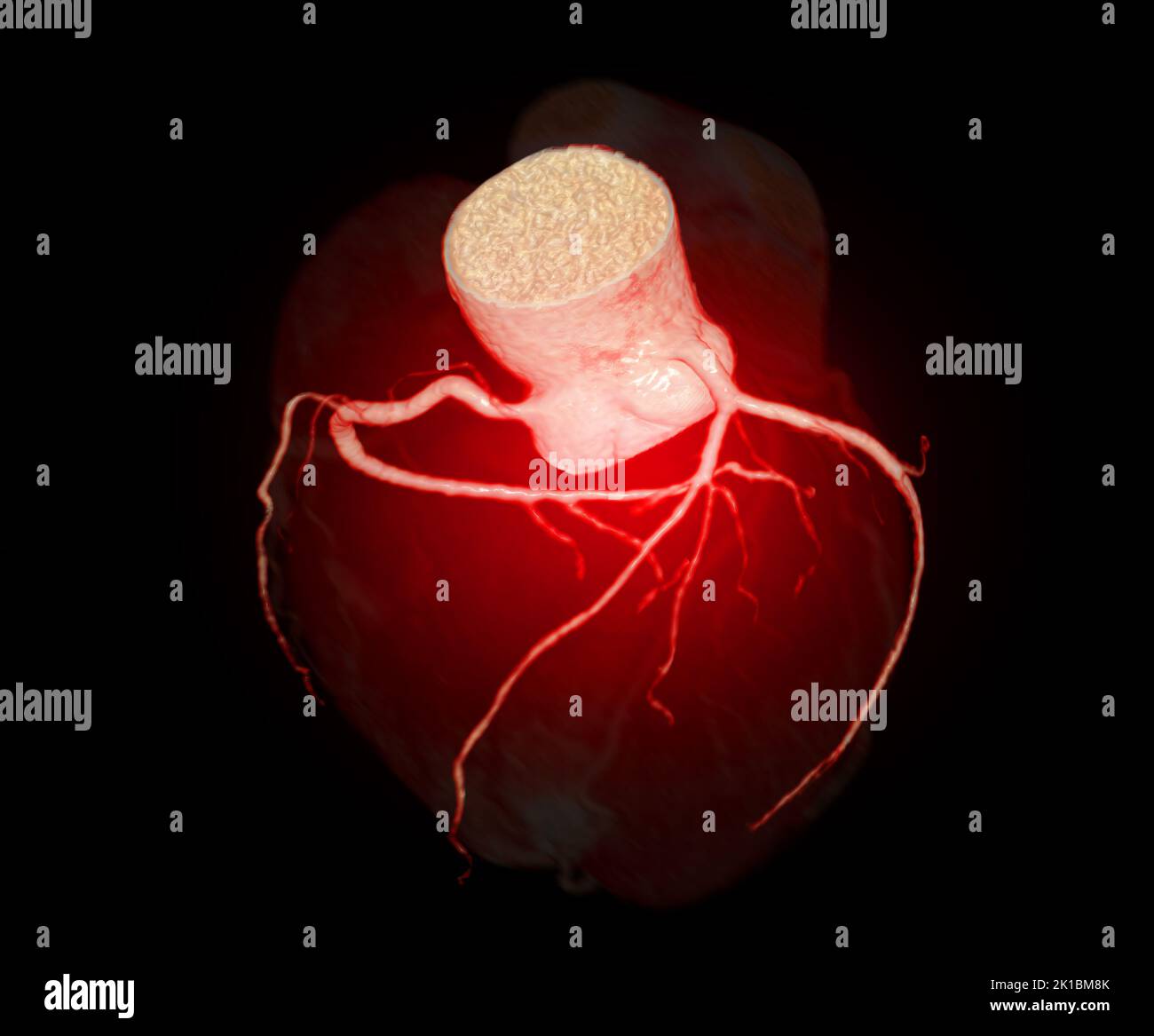 CT Cardiac 3D or CTA coronary artery for prevention coronary artery ...