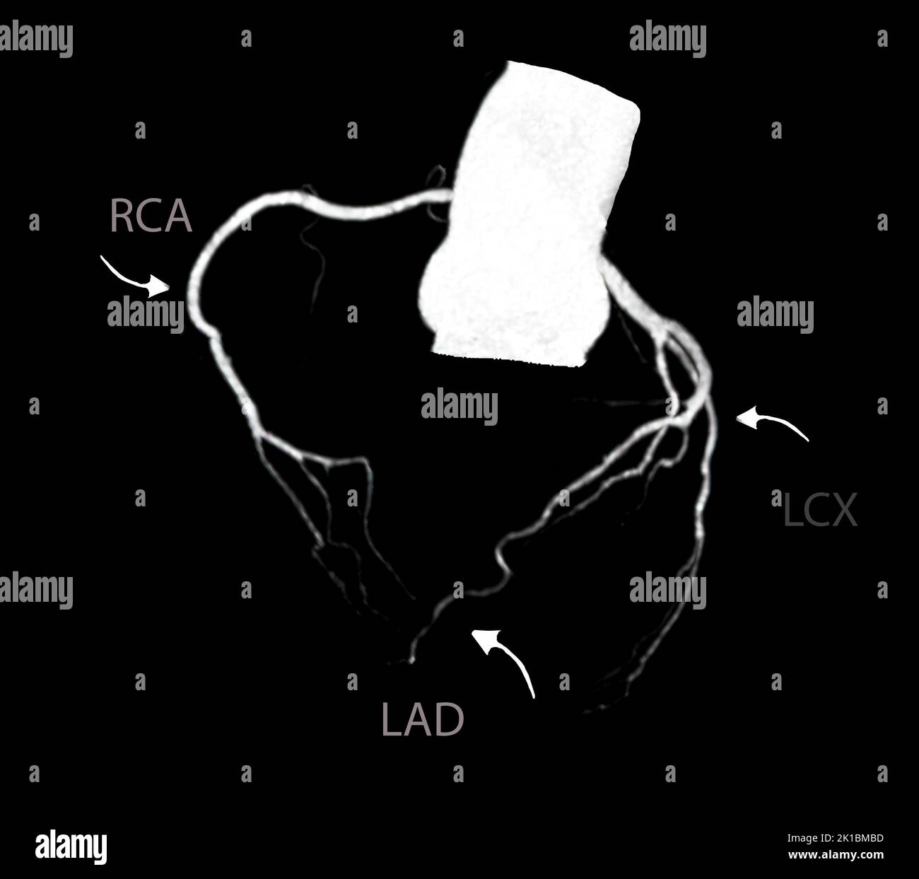 Coronary angiogram stent hi-res stock photography and images - Alamy
