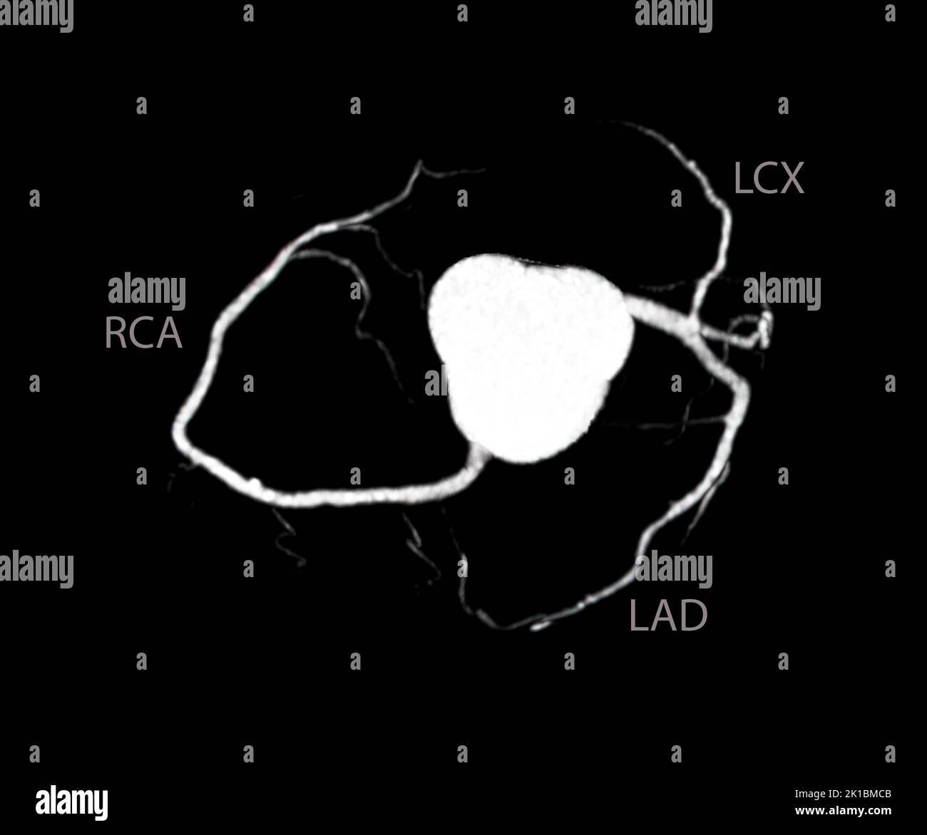 Coronary angiogram stent hi-res stock photography and images - Alamy