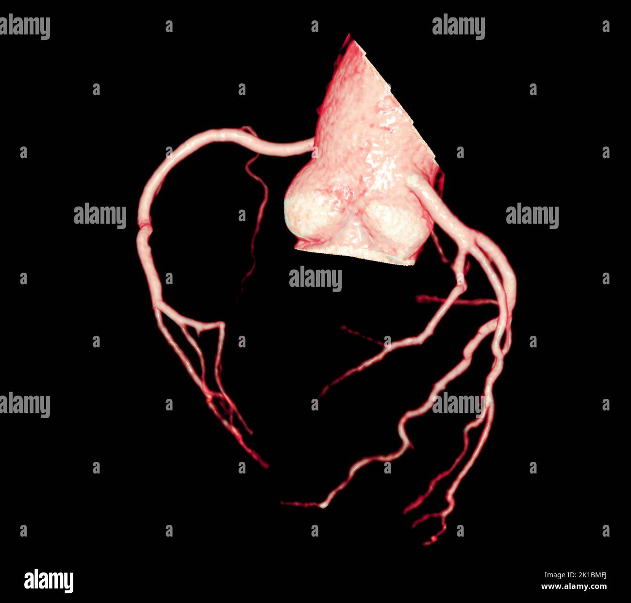 CT Cardiac 3D or CTA coronary artery for prevention coronary artery ...