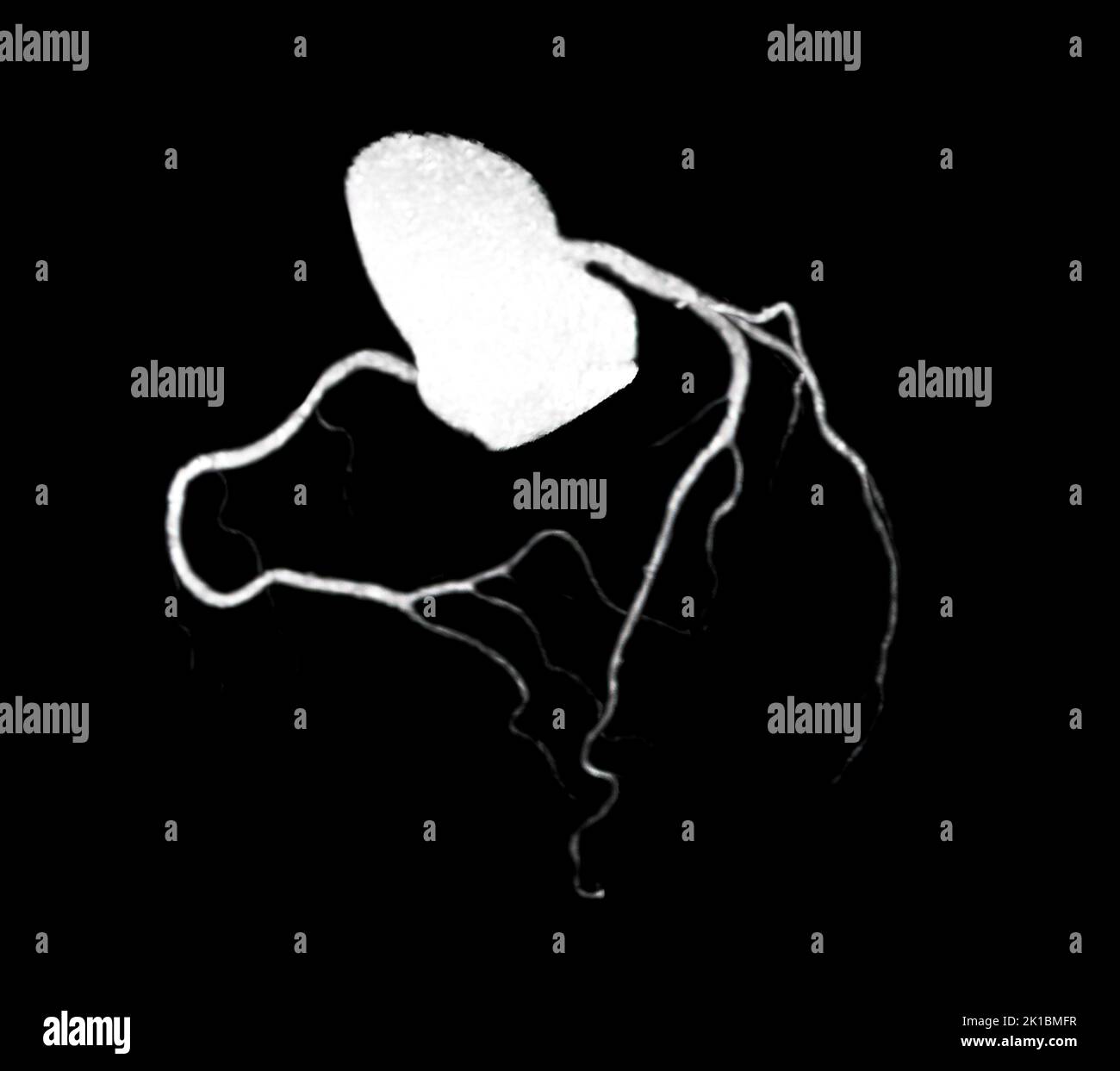 CT Cardiac 3D or CTA coronary artery for prevention coronary artery ...
