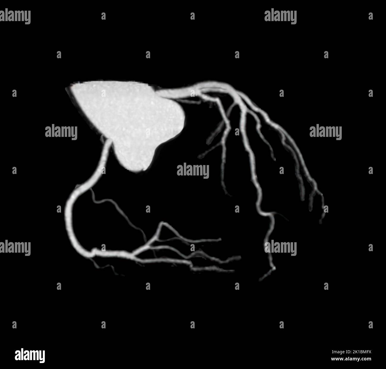 CT Cardiac 3D or CTA coronary artery for prevention coronary artery ...