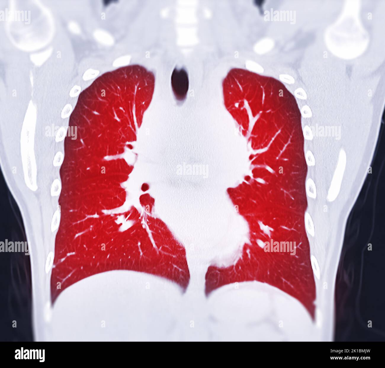 Ct lung coronal hi-res stock photography and images - Alamy