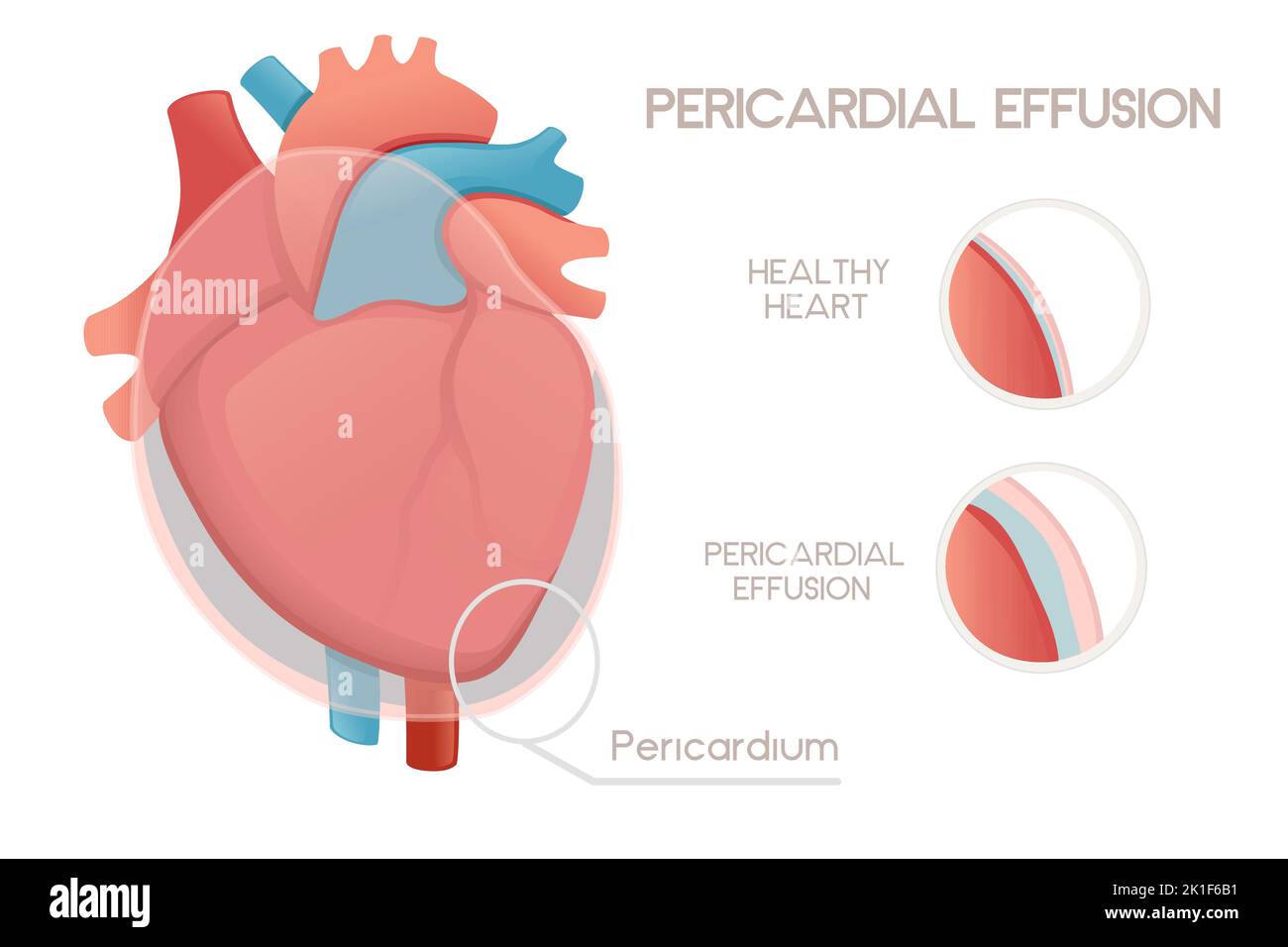 Pericarditis