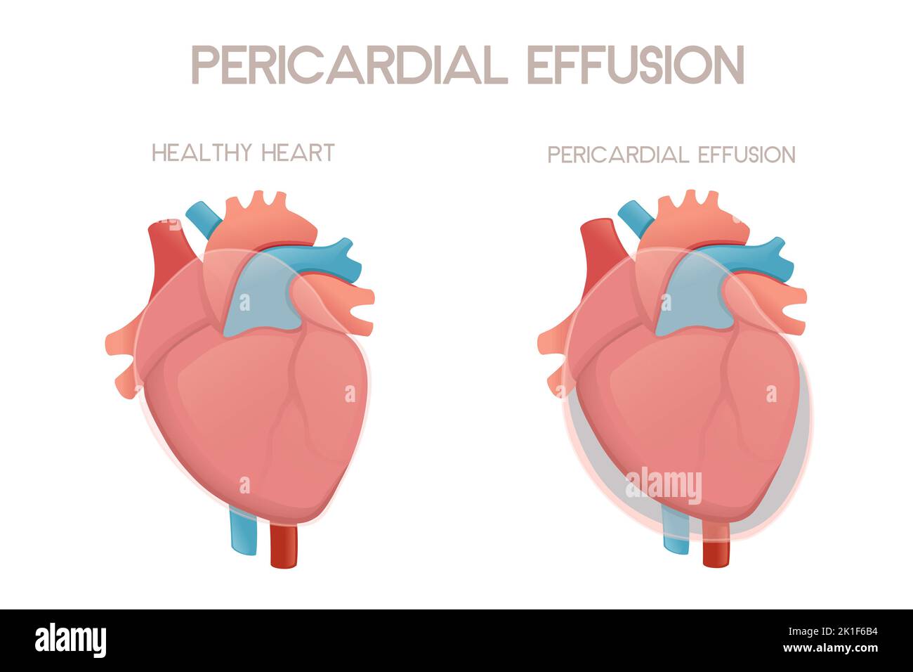 Pericarditis