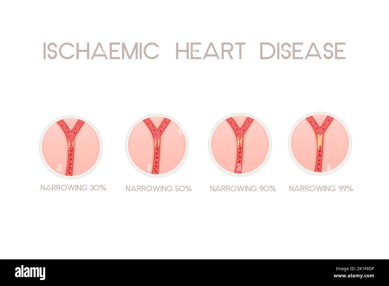 Unhealthy Human Heart With Ischemic Disease Anatomy Illustration Health