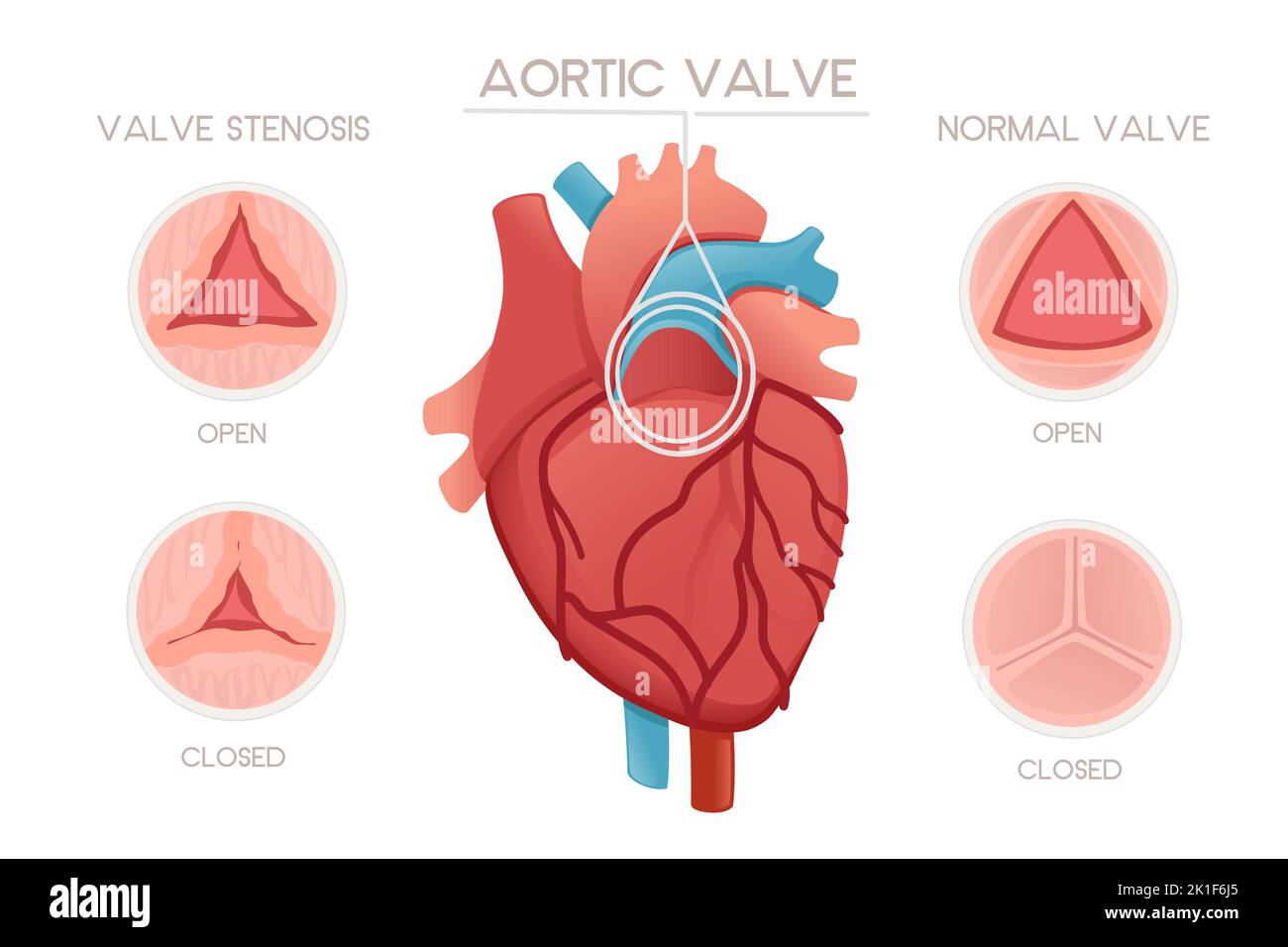 Healthy Human Heart With Valves And Valve Stenosis Disease Anatomy
