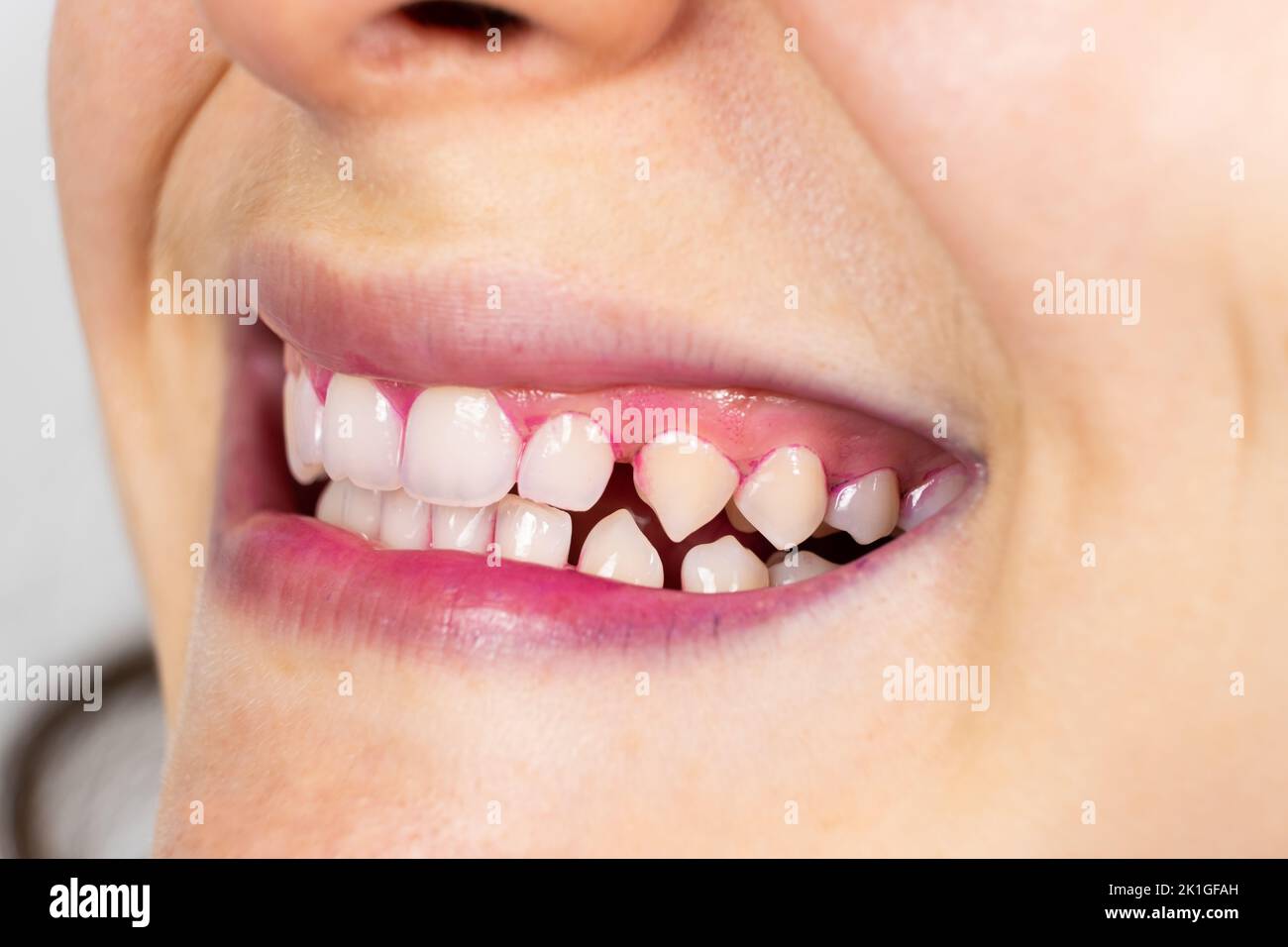 Plaque on human teeth is colored pink with indicator tablets Stock ...