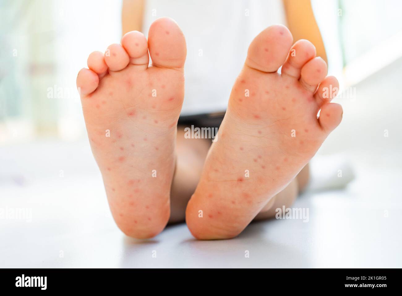 Enterovirus Leg - arm - mouth. Rash on the body of a child. Cocksackie ...