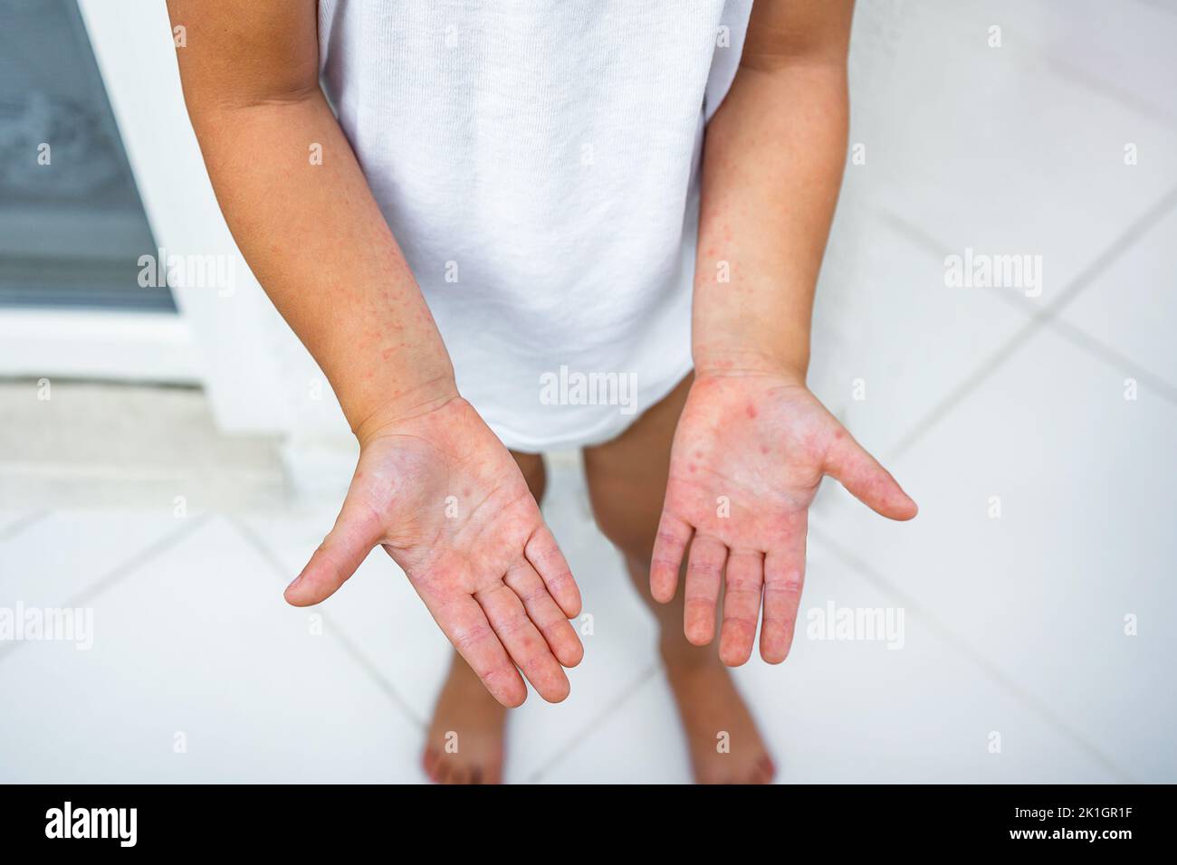 Enterovirus Leg - arm - mouth. Rash on the body of a child. Cocksackie ...