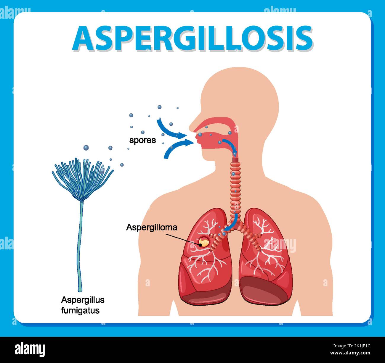 Diagram showing aspergillus infection illustration Stock Vector Image ...