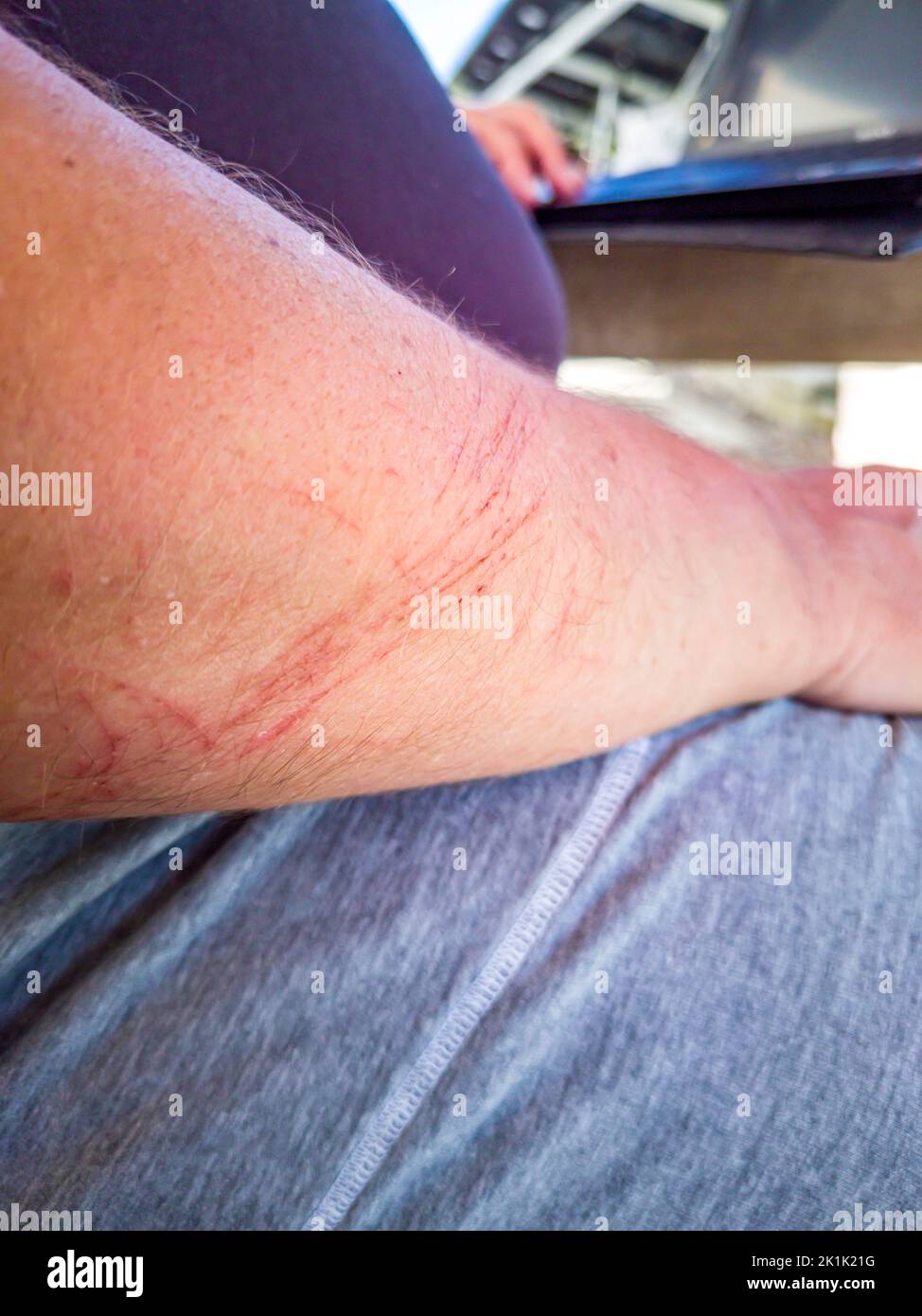 Scratchedd male arm after an accident Stock Photo - Alamy