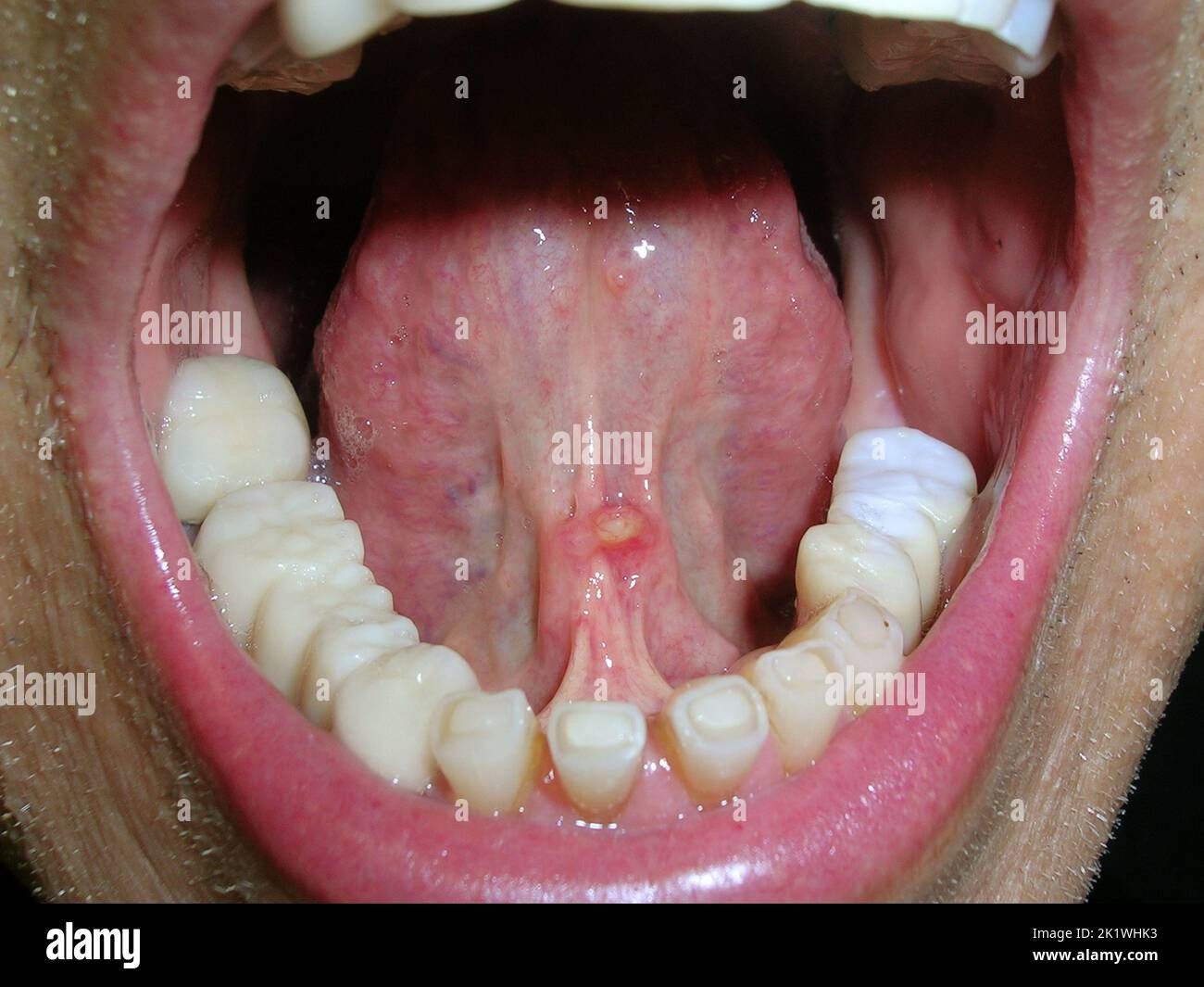 Mucocele under tongue Stock Photo - Alamy