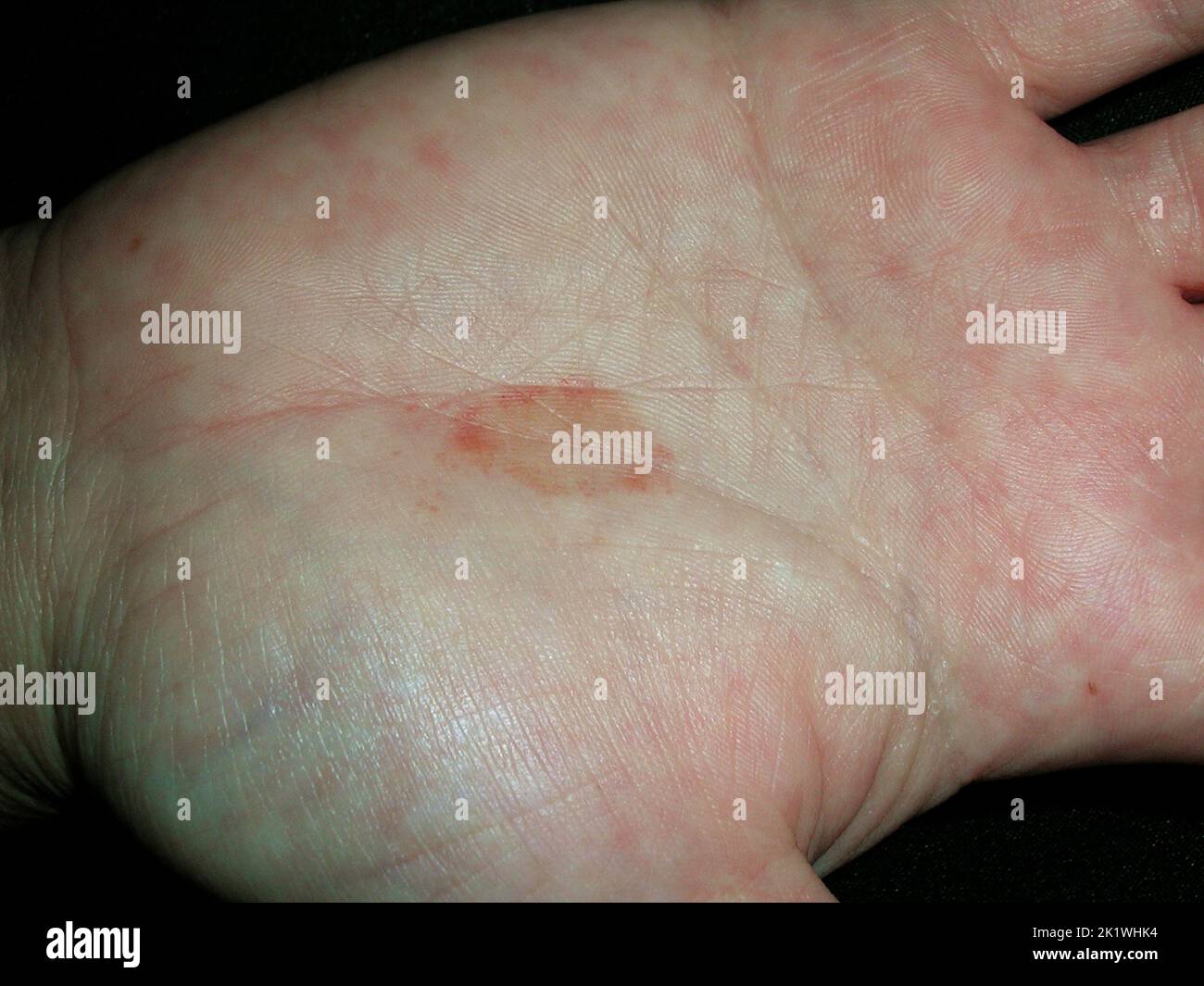 Pigmented purpuric dermatosis Stock Photo - Alamy