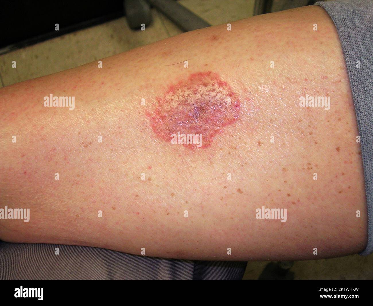 Pigmented purpuric dermatosis Stock Photo - Alamy