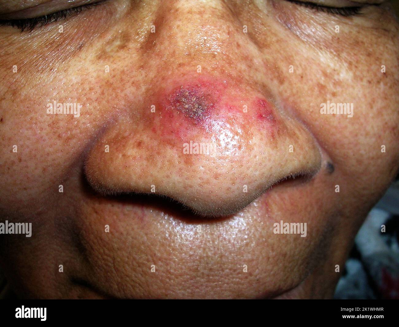 Discoid lupus erythematosus Stock Photo - Alamy