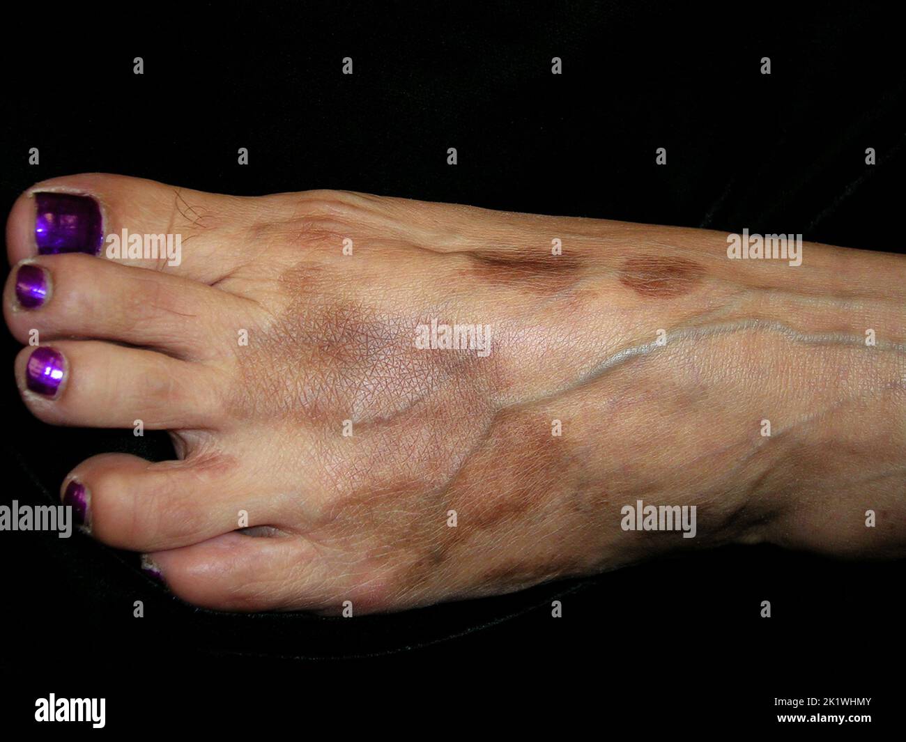 Pigmented purpuric dermatosis Schamberg Stock Photo - Alamy