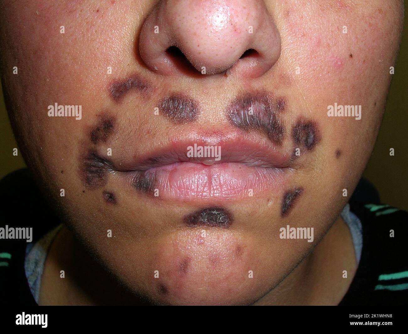 Discoid lupus erythematosus Stock Photo - Alamy