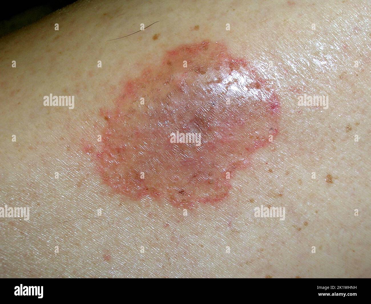 Pigmented purpuric dermatosis Stock Photo - Alamy