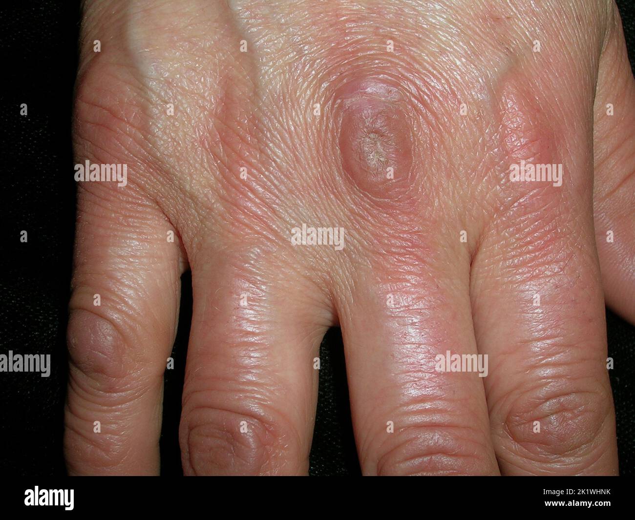 Gottron's papule in dermatomyositis Stock Photo - Alamy
