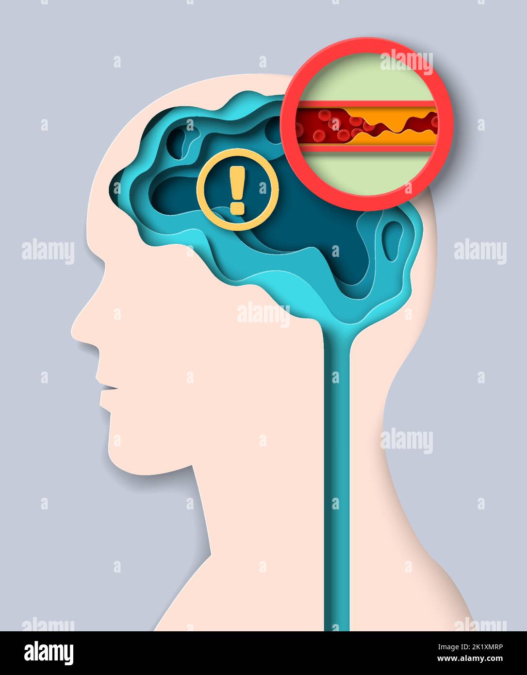 Brain stroke medical vector with human disease Stock Vector Image & Art - Alamy