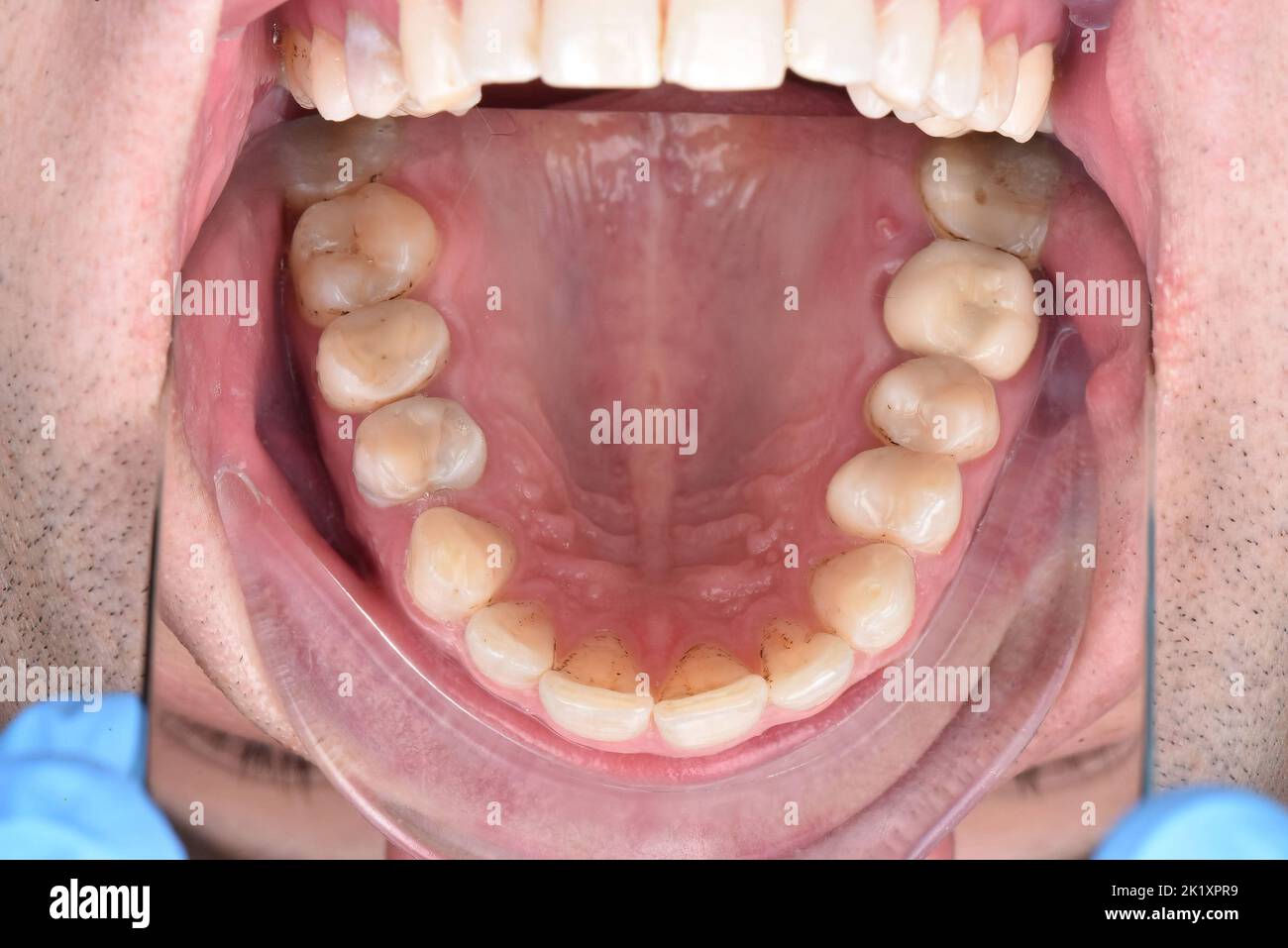 Open mouth human teeth close up hi-res stock photography and images - Alamy