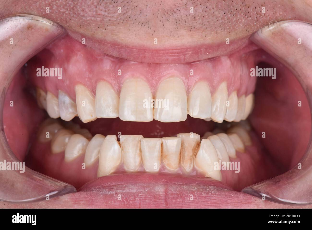 Close up front view teeth picture fixator gel braces before dental ...