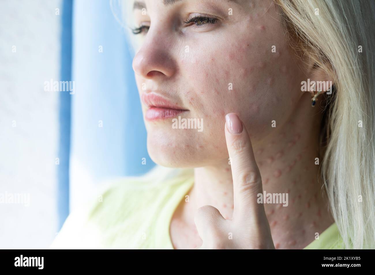 Woman papules face skin hi-res stock photography and images - Alamy