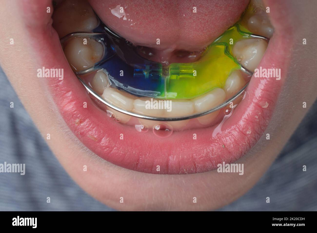 Mandibular plate, boy wearing teeth aligner, teeth and plate in detail ...