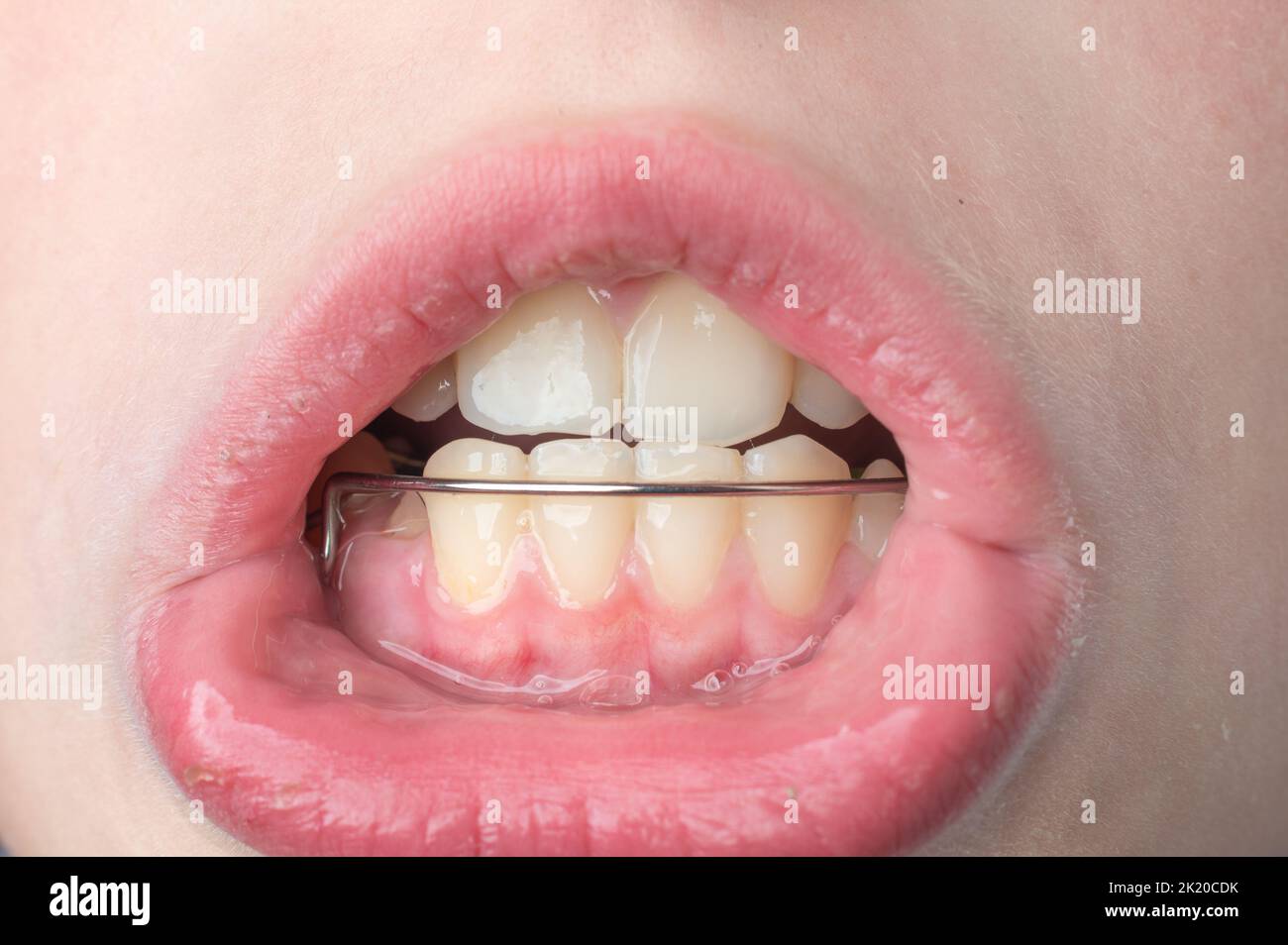 The boy wears a dental plate on the lower jaw, aligning children's ...