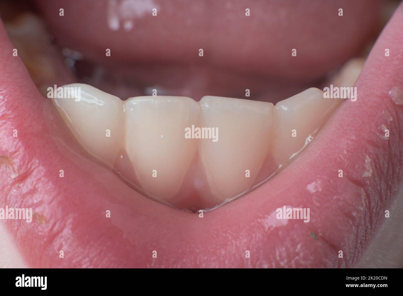 Jaw with children's straight teeth close-up, permanent front teeth of ...