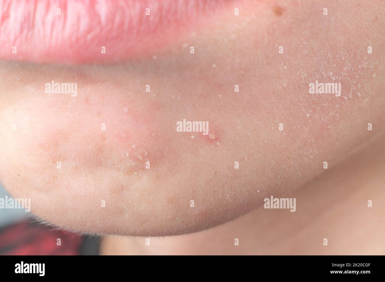 A teenager has a white pimple on his beard, a pimple on a child's face ...