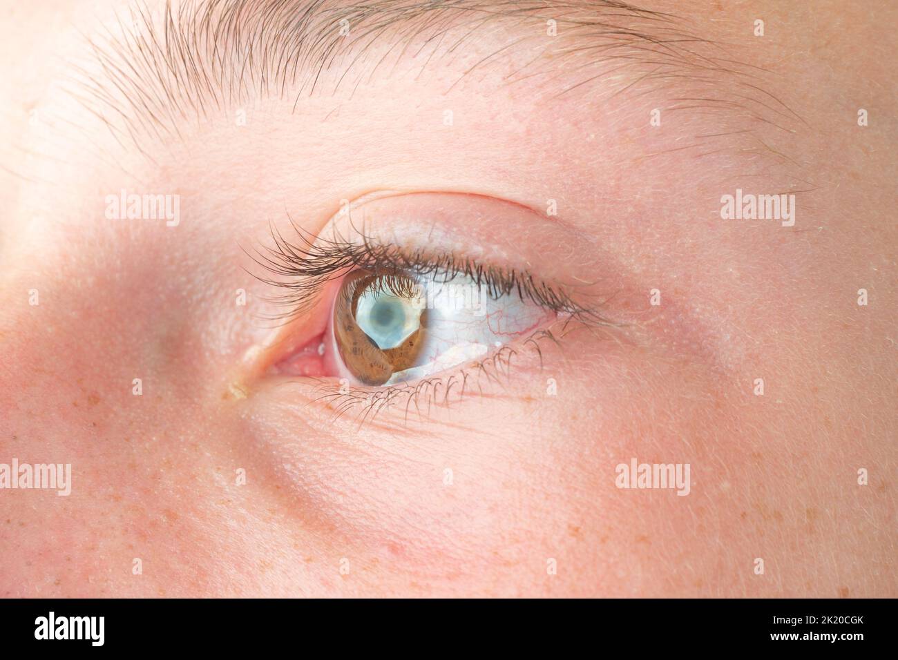 The formation of a tear in the eye, a child crying because of pain and ...