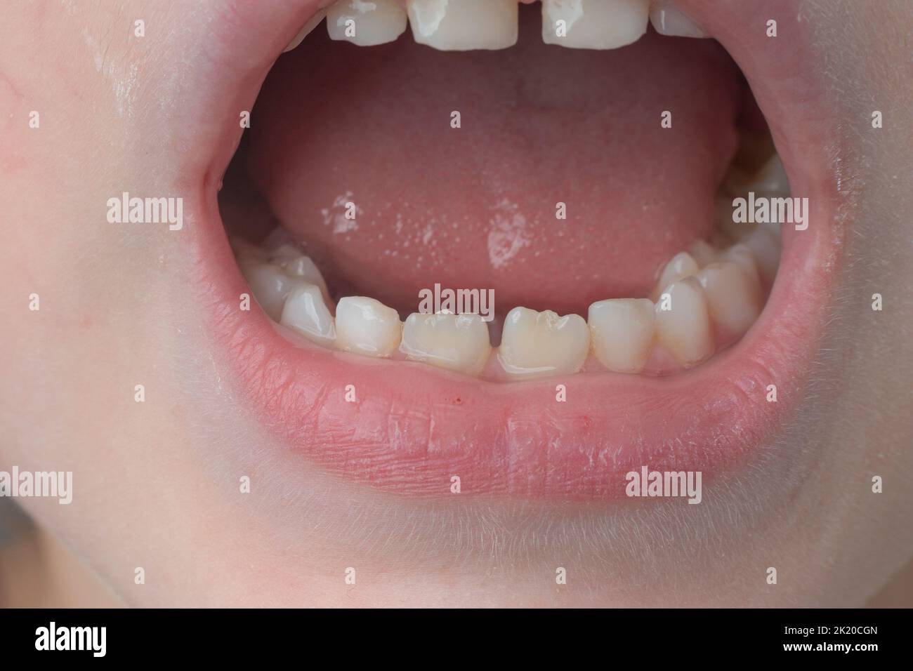 Jaw with child's even teeth close-up, milk and permanent teeth in a ...