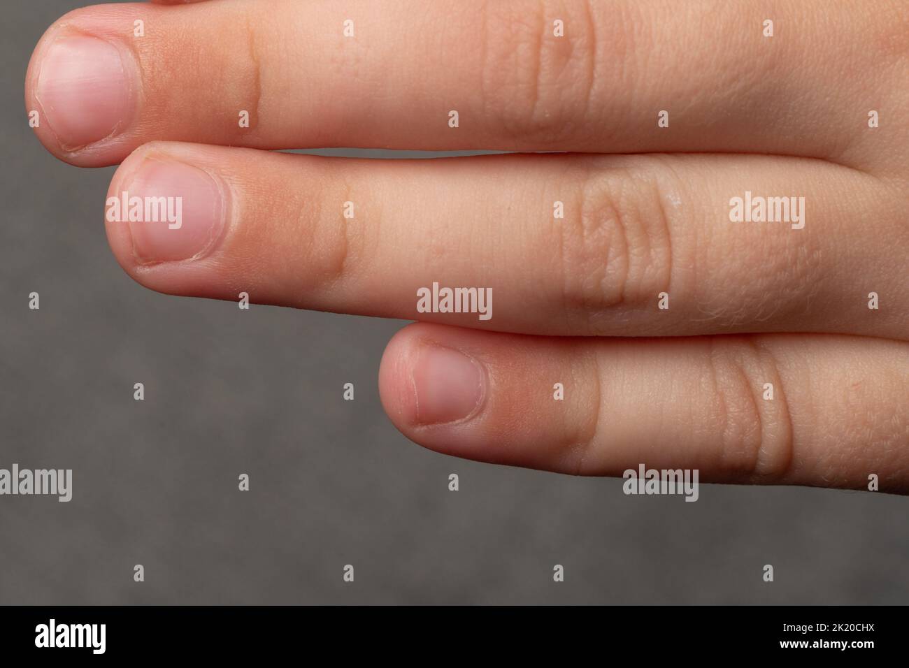 Dirty and sloppily trimmed child's fingernails, fingers and toenails ...