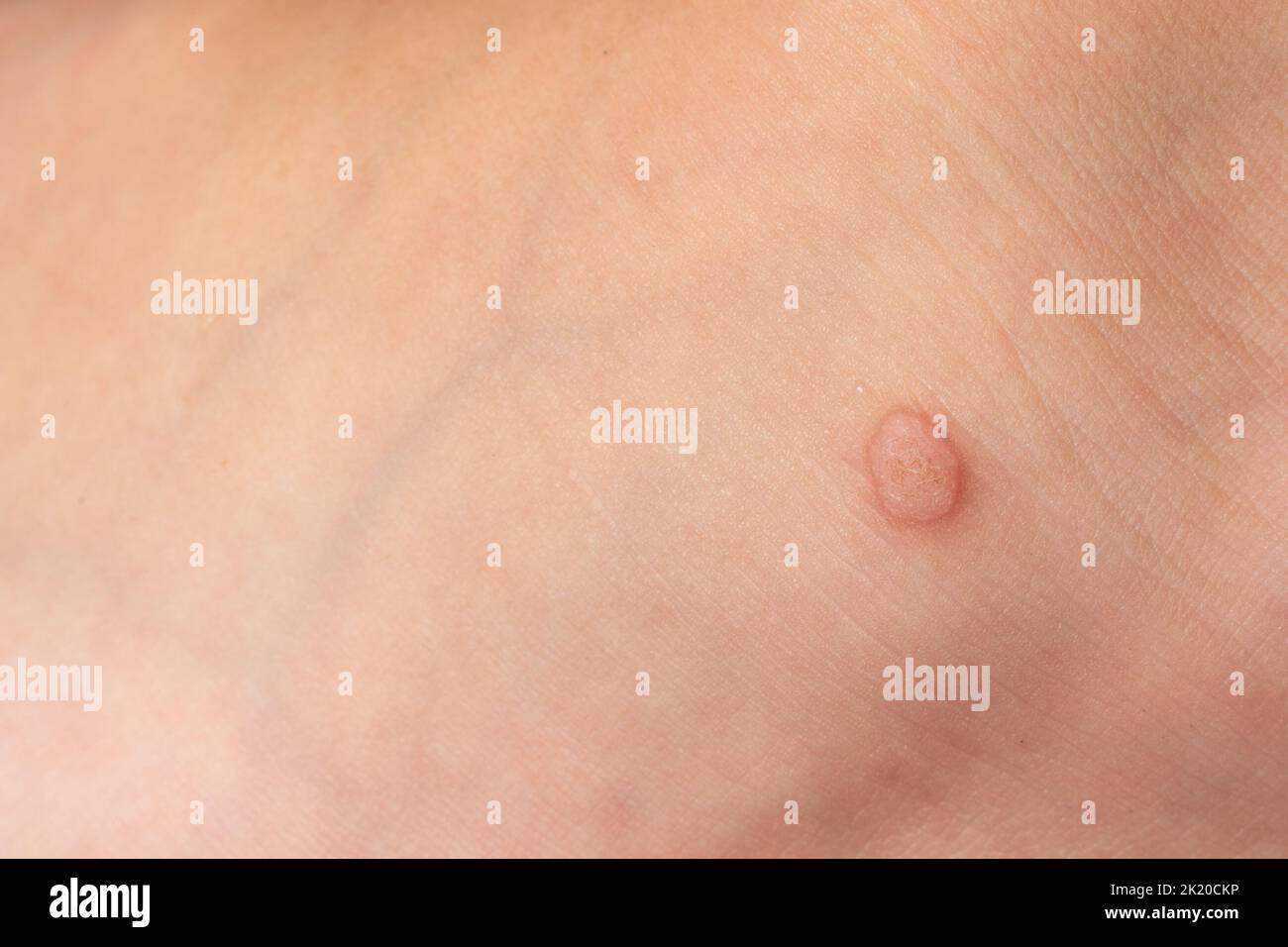 Child Getting Lots Of Warts at Lynn Potter blog