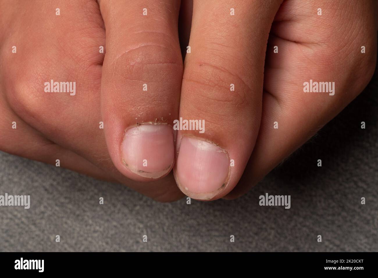 Cuticle wound hi-res stock photography and images - Alamy